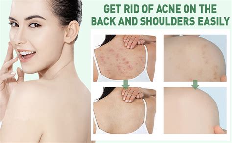 Back Acne Treatment Spray With Herbal Formula 2 Salicylic