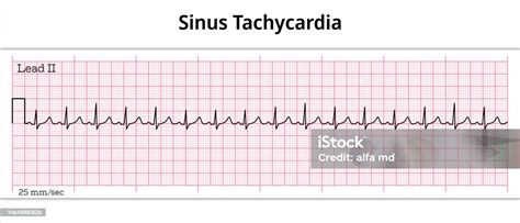 Ecg 부비동 빈맥 8 초 심전도 종이 빈맥에 대한 스톡 벡터 아트 및 기타 이미지 빈맥 맥박 추적 동방결절 Istock