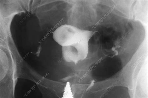 Uterine Fibroids Mri Scan Photograph By Zephyr 20 Week Scan Capturing