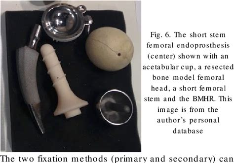 Figure 1 From An Alternative Femoral Stem Bone Implantation Technique Using An Innovative Short