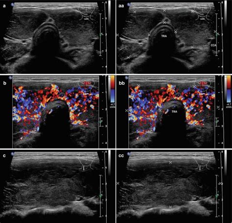 미만성 갑상선 질환 Diffuse Thyroid Disease 초음파 소견 손닥터
