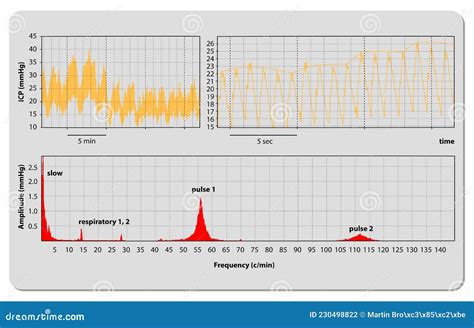 Intracranial Pressure Monitoring Icp Waveform 3d Render 2d Graphic
