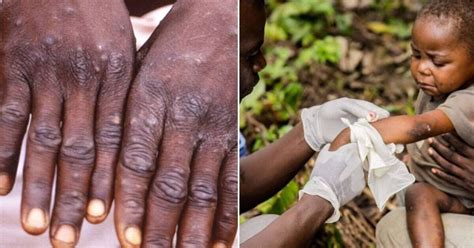What Is Mpox Symptoms Causes And Everything We Know As Who Declares Emergency Health News
