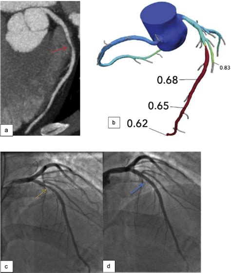 Hemodynamically Significant Lesion Of Intermediate Stenosis Degree