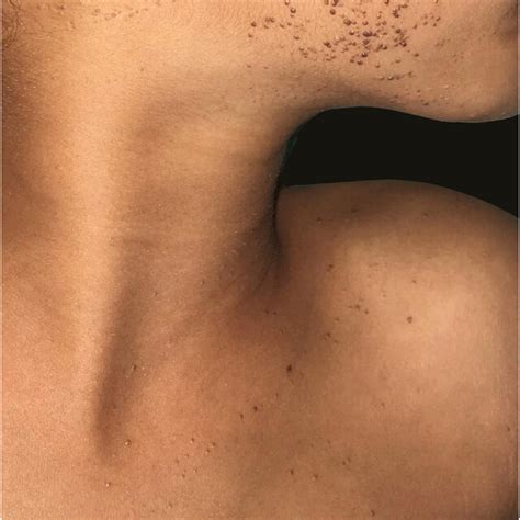 Proliferation Of Basaloid Epithelioid Cells In Strands And Islets Download Scientific Diagram