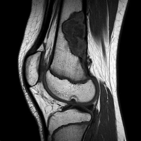 Ossifying Fibroma Femur Management Of Paediatric Benign Bone Tumour