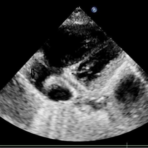 Echocardiography Parasternal Short‐axis View The White Arrow Shows