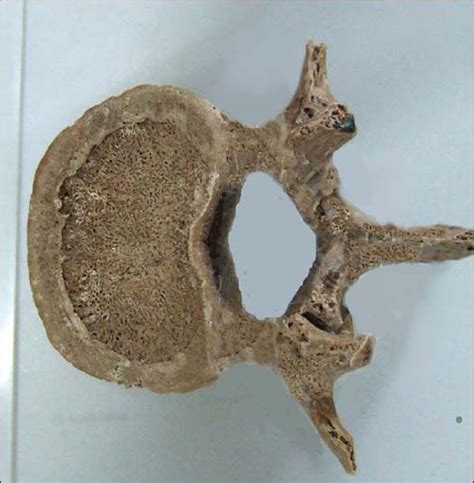 Evaluations Of Computed Tomography Images And Lumbar Specimens In Mimic