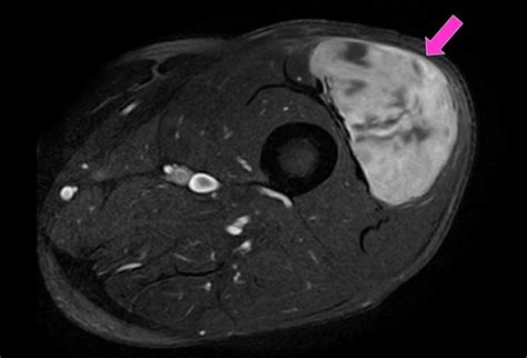 Soft Tissue Sarcomas What You Need To Know