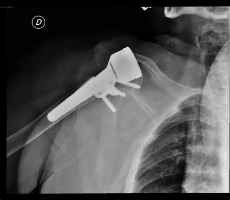 Radiopaedia Case Reverse Shoulder Prosthesis Anterior Dislocation Id