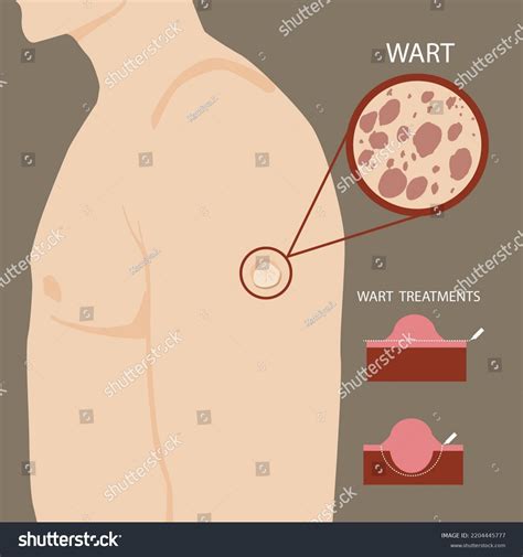 Arm Warts On Male Body Closeup Stock Illustration 2204445777 Shutterstock