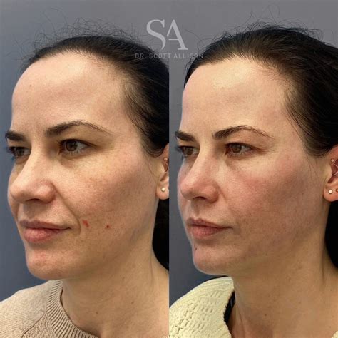 Laser For Frown Lines