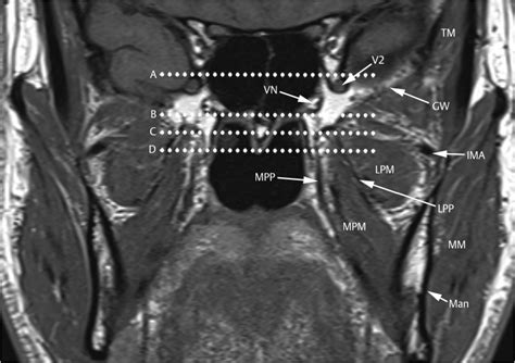 16 Infratemporal Fossa Approach Neupsy Key