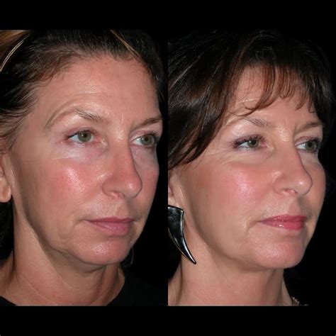 Bio Identical Hormone Replacement Therapy Maryland Plastic Surgery