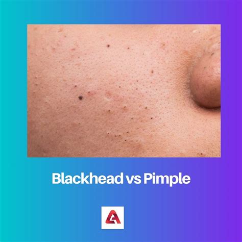 Blackhead Vs Pimple Difference And Comparison