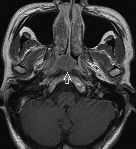 Adenoid Hypertrophy Diagnosis