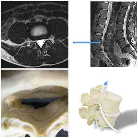 Disk Degeneration And Lower Back Pain Causes Symptoms And Treatment