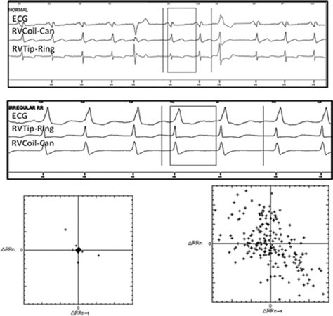 Ecgegm And Corresponding Lorenz Plots The Top Ecg Figure Is Of Normal