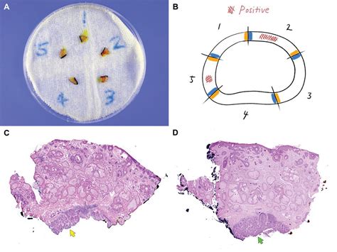 Clinicopathological Factors Influencing Resection Margin Involvement During Mohs Micrographic