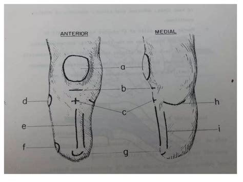 Patellar Tendon Bearing Prosthesis Pptx