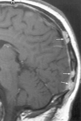 Hemangioma Mri