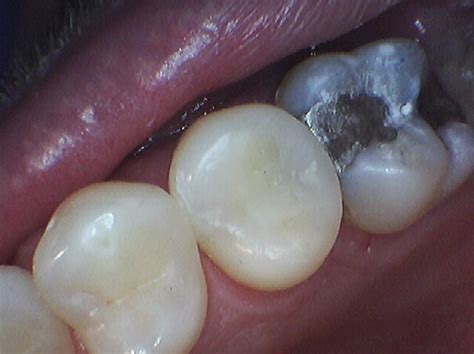 The Use Of Rubber Dams Affinity Dental Care Burlington