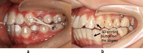 A Class Ii Elastics Engaged On The Mesiobuccal Surface Of The
