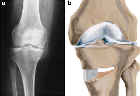 A Pre Operative Radiograph Of A Patient With Varus Deformity B The