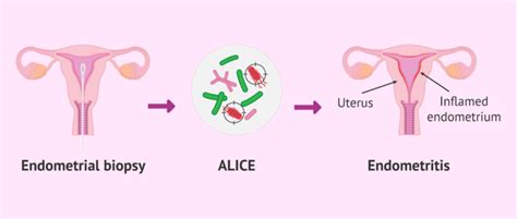 ALICE Test To Diagnose Endometritis
