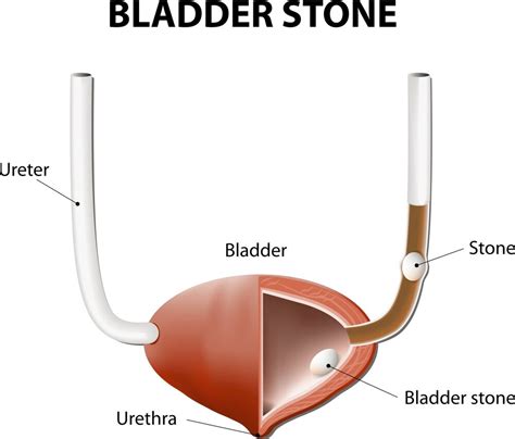 Bladder Stones Fairbanks Urology