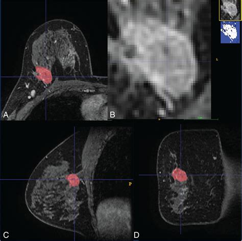 Artificial Intelligence—enhanced Breast Mri And Dwi Current Status And