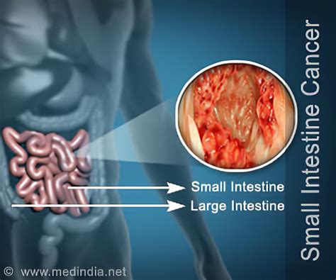 Intestinal Cancer