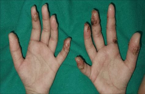 A And B Multiple Pustules Collapsing To Form Lake Of Pus Over Distal