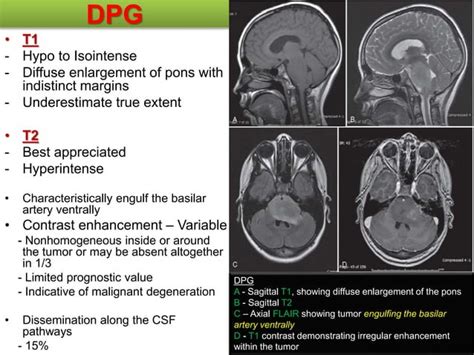 Brainstem Glioma Part 1 Pptx