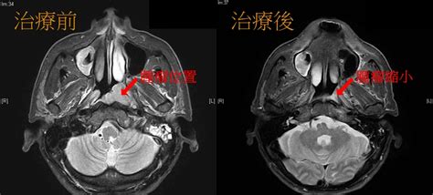 反覆流鼻血近一個月 意外發現鼻咽癌 Uho優活健康網