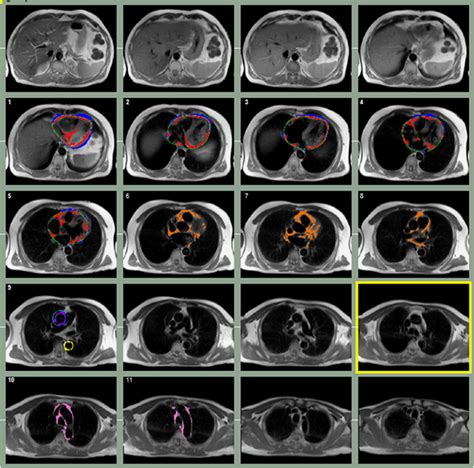 Segmentation Of Epicardial Fat Red Paracardial Fat Blue