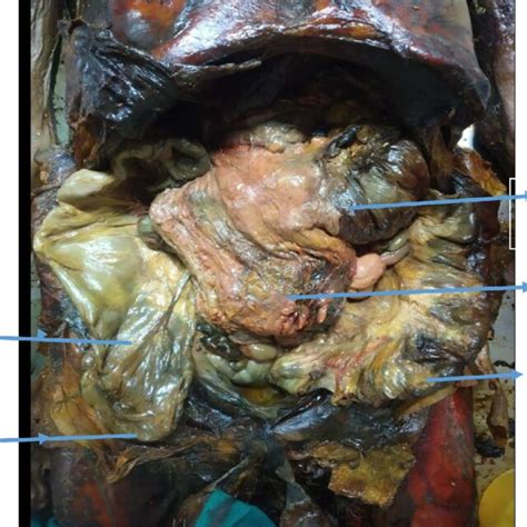 Ct Abdomen And Pelvis Without Contrast Whirl Sign Displaying Cecal