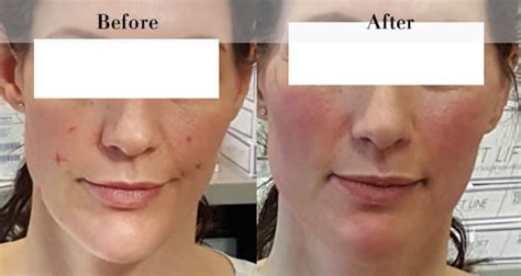 Pdo Threads In Liverpool Thread Lift And Non Surgical Facelifts