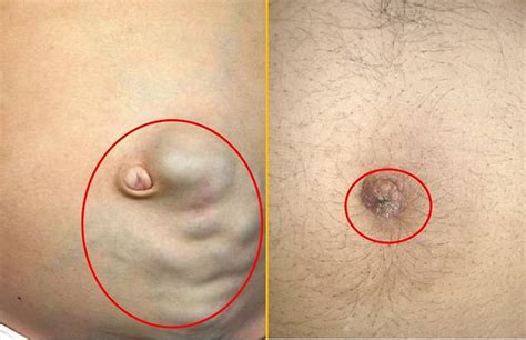 메두사 머리처럼 배꼽 주변이 울퉁불퉁 이 병 있다는 신호