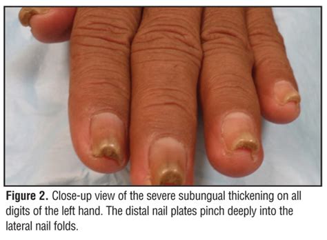 Pincer Nail Cause Nail Ftempo