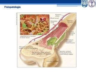 Osteomielitis Segun El Hpor De Barquisimeto Ppt
