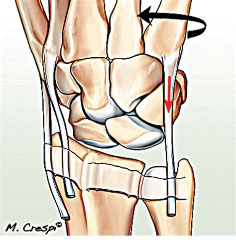 Isometric Contraction Of The Muscle Attaching To The Base Of The Fifth