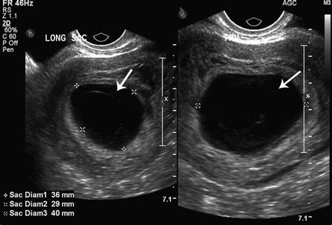 First Trimester Ultrasound Early Pregnancy Failure Radiology Key