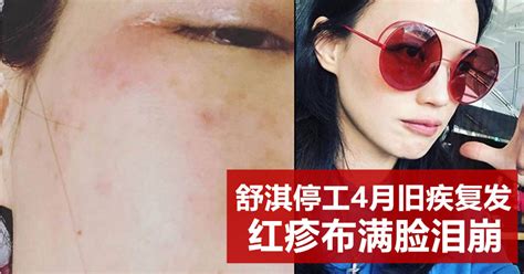 舒淇停工4月旧疾复发 红疹布满脸泪崩 辣手网