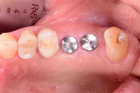Minimally Invasive Maxillary Sinus Lift With Lateral Approach From A To Z