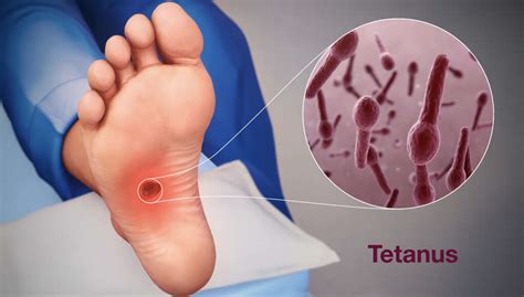 Tetanus What Is Tetanus