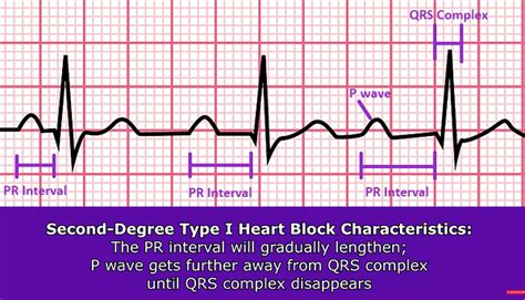 Av Heart Blocks Comprehensive Ecg Interpretation Vrogue Co