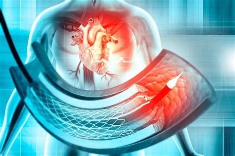 Qué es un cateterismo cardíaco Cardiopatías Congénitas La Paz
