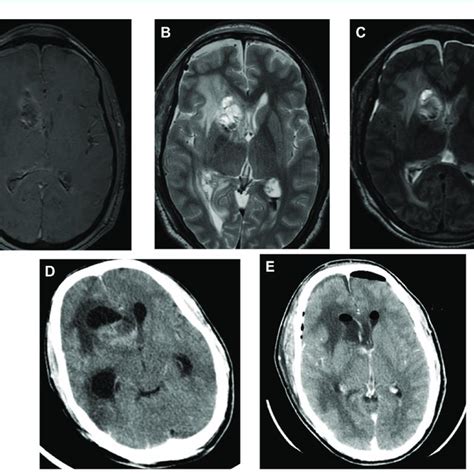 Caudate Region Intracranial Cryptococcoma With Intraventricular
