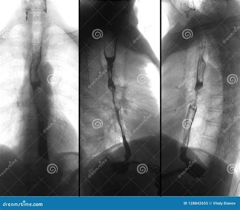 X Ray Of The Upper Gastrointestinal Series Ugi With Barium Cancer Of